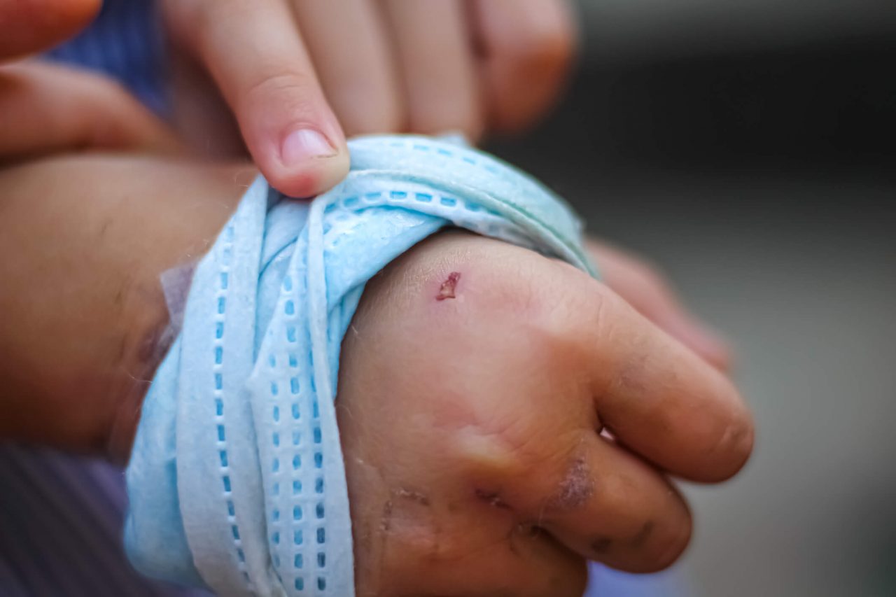 What Happens After A Dog Bite Is Reported - Dog Bite King Las Vegas